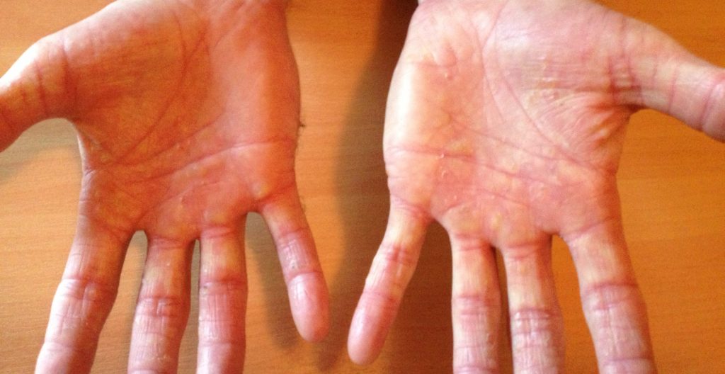 ECZEMA - Naturopath Dermatological Sunshine Coast Montville Queensland